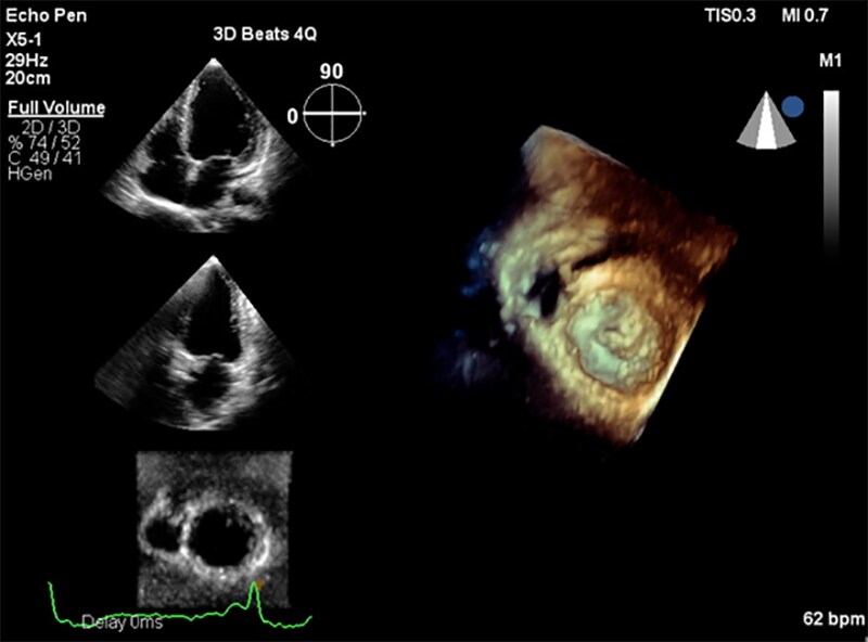 It's high time for EPIQ | Philips Healthcare